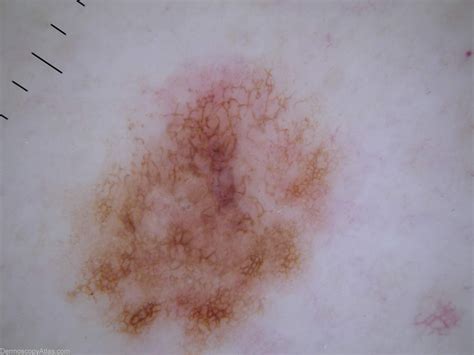 Dermoscopy Atlas Diagnosis Detail