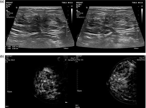 Microcalcification Of A Solid Breast Nodule A Microcalcifications Download Scientific