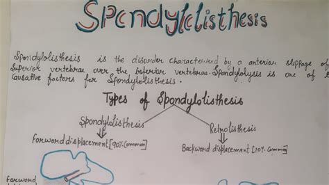 Introduction Spondylolisthesis Types Etiology Classification