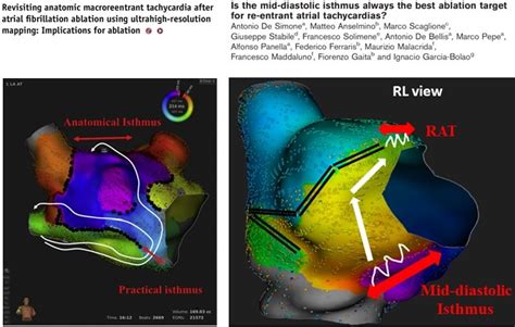 Rhythmia Hdx Evidenze Cliniche Nel Flutter Atipico Aiac