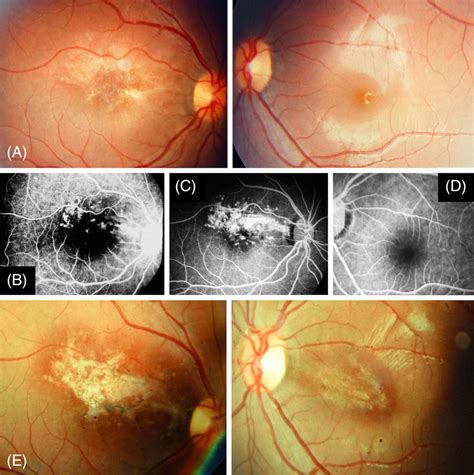 A 14‐year‐old Girl Was Diagnosed With Subacute Sclerosing Download