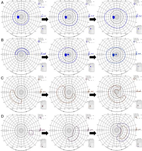 Improvement Of Visual Field Defect Overtime In Eyes With Central