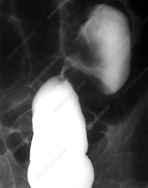 Twisted Sigmoid Colon X Ray Stock Image M290 0167 Science Photo Library