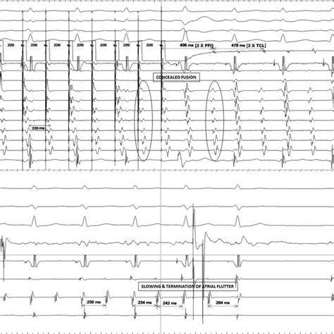 A Represents Surface Ecg And Intracardiac Egms During Entrainment From Download Scientific