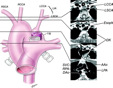 Right Aortic Arch With Aberrant Left Innominate Artery Circulation