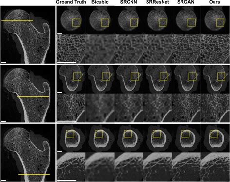 A Super Resolution Diffusion Model For Recovering Bone Microstructure