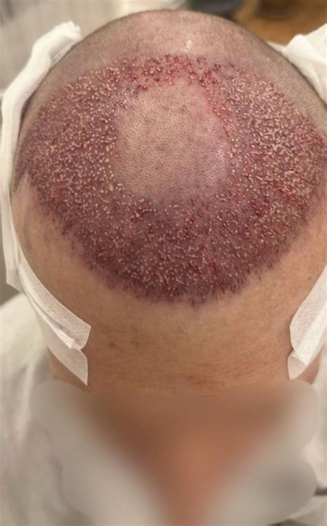 Ozlem Bicer Md Hair Transplant 3160 Grafts Fue By Micro Motor 12