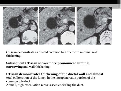 Cholangiocarcinoma Sudhan Radiological Imaging Ppt