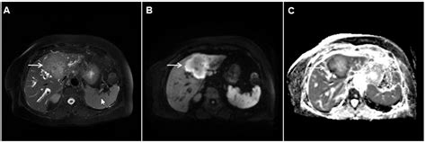 Current Oncology Free Full Text Imaging Spectrum Of Intrahepatic Mass Forming