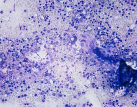 Signs And Symptoms Of Bone Marrow Disease