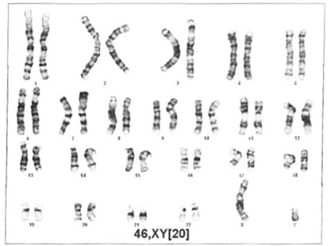 Rce010 A Rc 6 Was Analysed By Giesma Staining Of 20 Metaphase Spreads