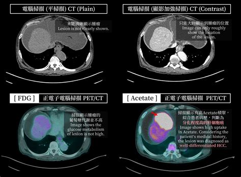 Advanced Imaging Technique For Hong Kongs Third “cancer Killer” Liver Cancer 聖德肋撒醫院 掃描部
