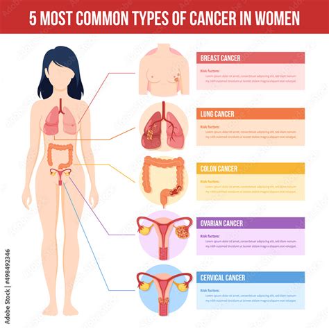 Top 5 Most Common Cancers