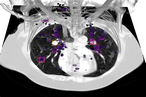 A Lung Nodule Annotation In A Ct Image Of The Lidc Idri Collection