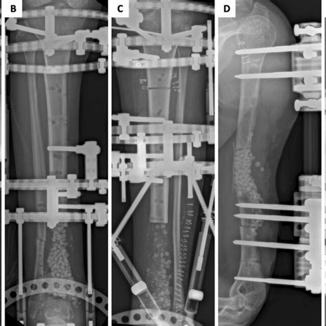 Distal Tibia Osteomyelitis In Patient 1 A C Ap Radiographs Of The