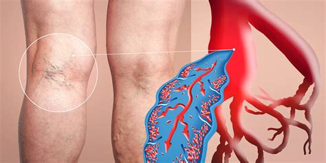 Understanding Superficial Vein Reflux Symptoms And Treatment Options