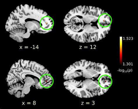 Searchlight Results Identified Bilateral Regions In The Medial Download Scientific Diagram