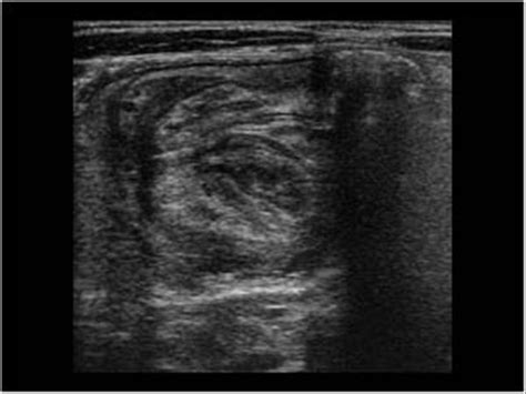 Pediatrics 9 1 Pediatric Abdomen And Retroperitoneum Case 9 1 2 Intussusception Ultrasound