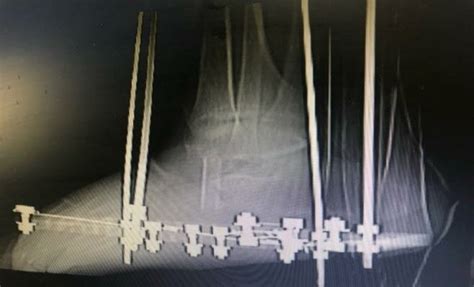 No Neoplastic Multinucleated Giant Cells Orange Mononuclear Tumour