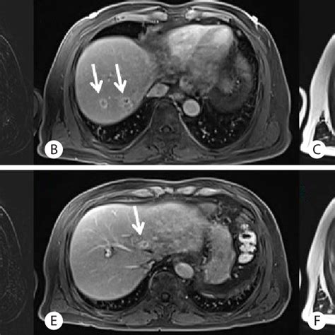 Magnetic Resonance Image Showed Multiple Lesions In Liver White Download Scientific Diagram