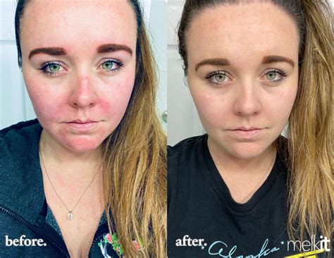 Before And After Melkit