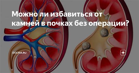 Можно ли избавиться от камней в почках без операции Дзен