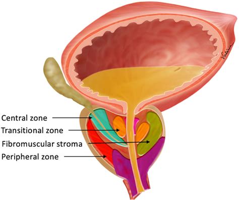 Prostatic Artery Embolization Indications Preparation Techniques Imaging Evaluation