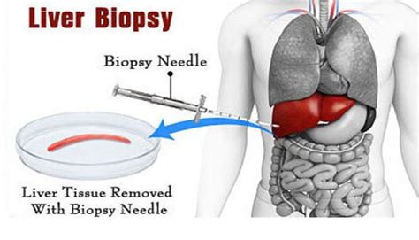 What Is A Fibroscan Hepatitis C Treatment