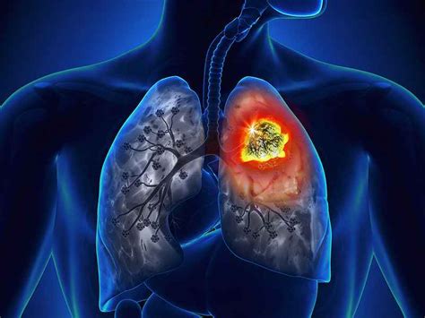 Ai Can Now Determine Lung Cancer Type Indian Bureaucracy Ias Ips