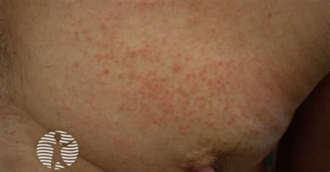Contact Allergic Dermatitis Of The Torso Image