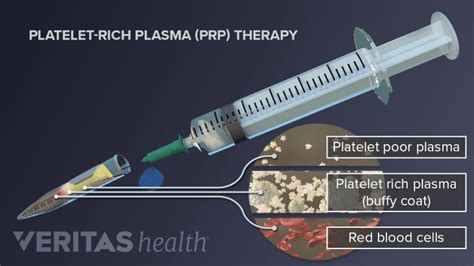 Platelet Rich Plasma Injection Procedure