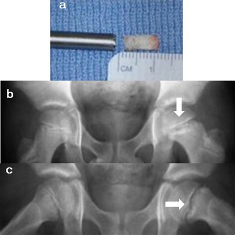 A Core Biopsies Of The Proximal Femoral Growth Plate Were Performed