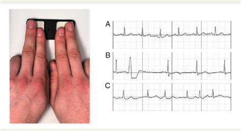 Figure From Detection Of Atrial Fibrillation With A Smartphone Camera First Prospective