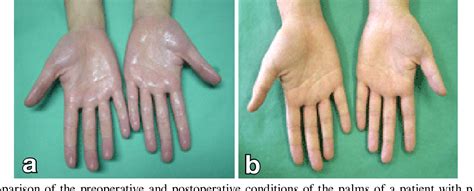 Figure 1 From Patient Satisfaction After Endoscopic Thoracic Sympathectomy For Palmar