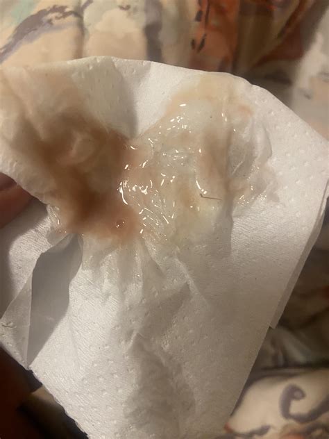 Not Your Regular Case Of Strep Throat More In The Comments R