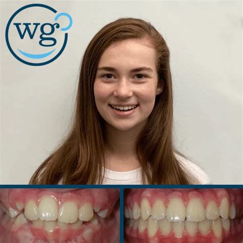 Overbite Braces Progress