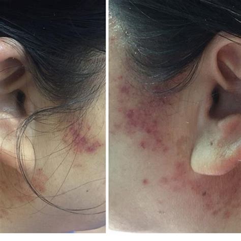 Resolution Of Skin Lesions On The Forehead Both Ears And Posterior Download Scientific