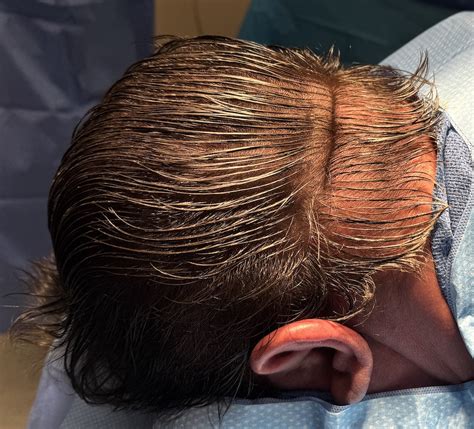 Left Back Oif The Head Scalp Indenttaion Dr Barry Eppley Explore
