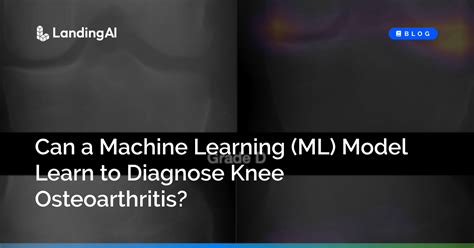 can a machine learning ml model learn to diagnose knee osteoarthritis