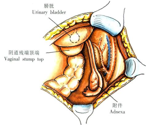 腹式阴道根治术 妇产科手术 医学