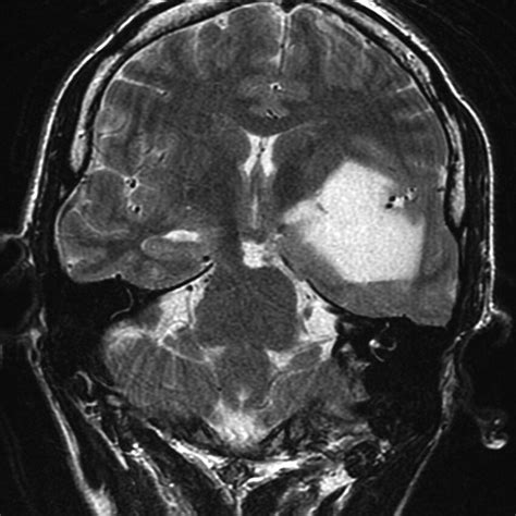Radiopaedia Case Diffuse Astrocytoma Nos Id 10183 Study 10718 Nc