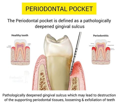 Periodontal Pocket Medizzy