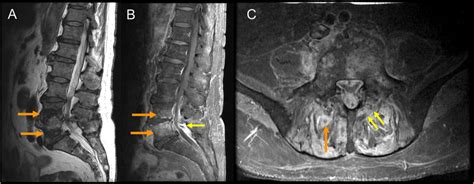 A Sagittal T2 Weighted Turbo Spin Echo Pulse Sequence Shows Remarkable Download Scientific