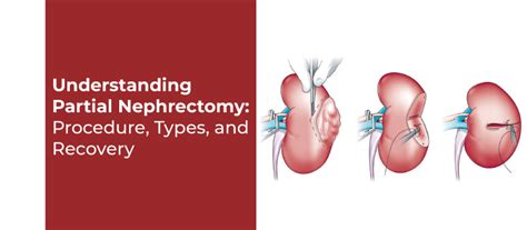 Understanding Partial Nephrectomy Procedure Types And Recovery