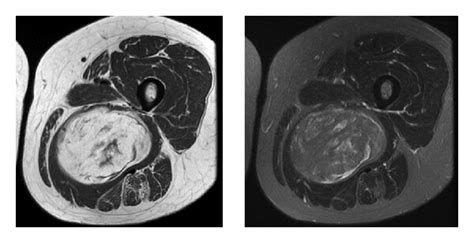 Can Experienced Observers Differentiate Between Lipoma And Well