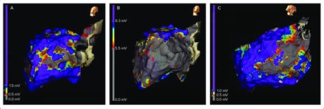 Endocardial And Epicardial Voltages Download Scientific Diagram