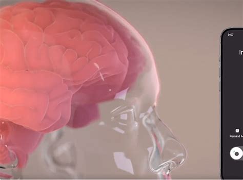 Neuralink Implants Chip Into Humans Brain By Elon Musks Company Wtf Montreal Times