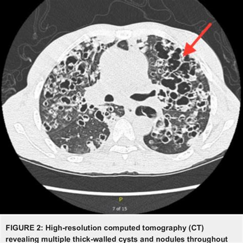 Chest X Ray Revealing Bilateral Coarse Reticulonodular Opacities And Cysts Download Scientific