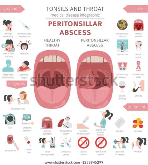 Tonsils Throat Diseases Peritonsillar Abscess Symptoms 스톡 벡터 로열티 프리