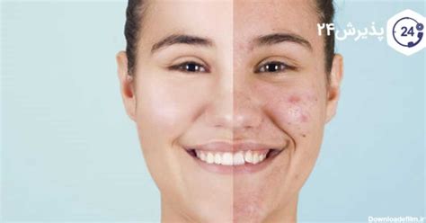 عکس دختر با صورت پر جوش